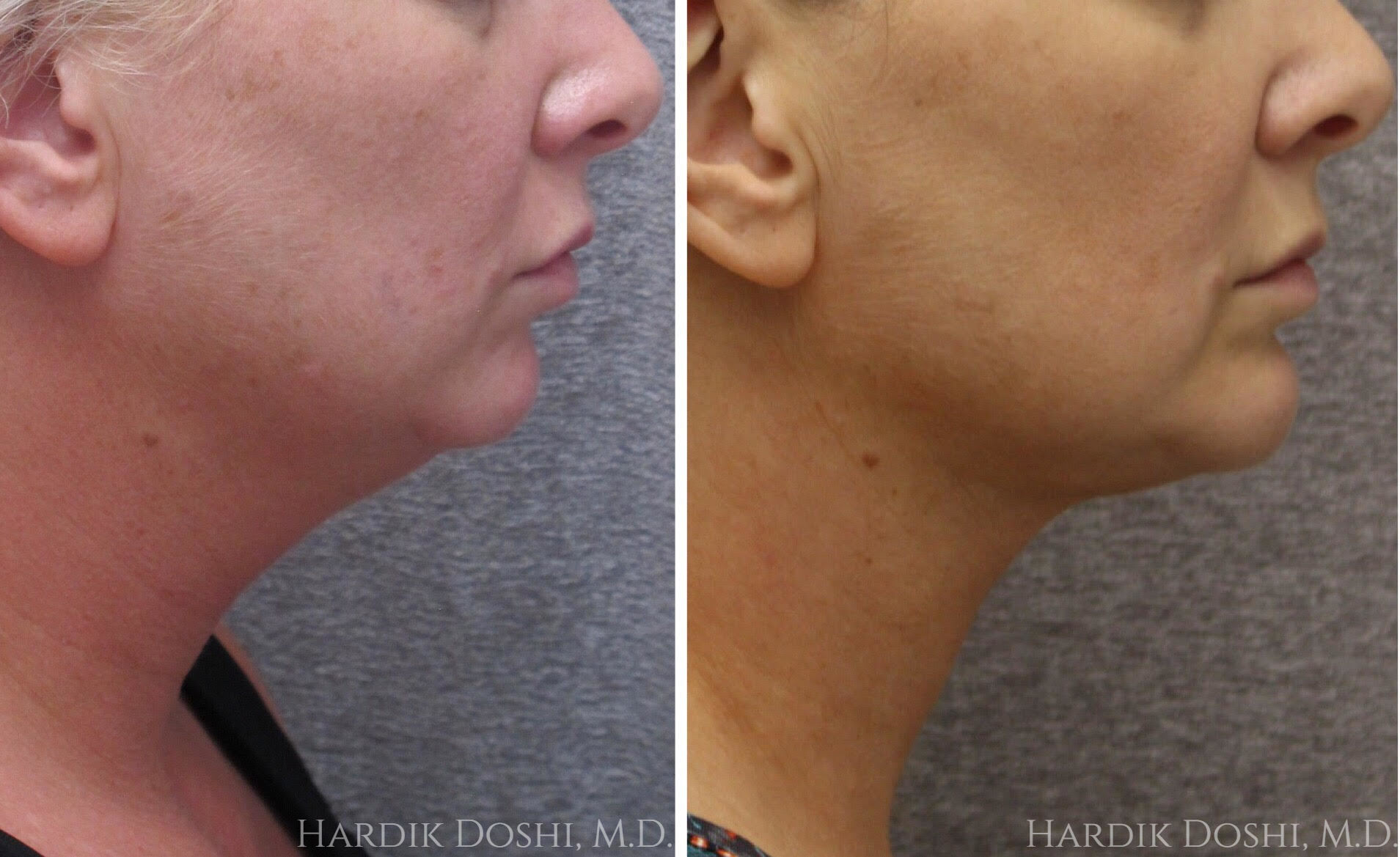 Best Neck Lift in Long Island | Platysmaplasty by Dr. Doshi