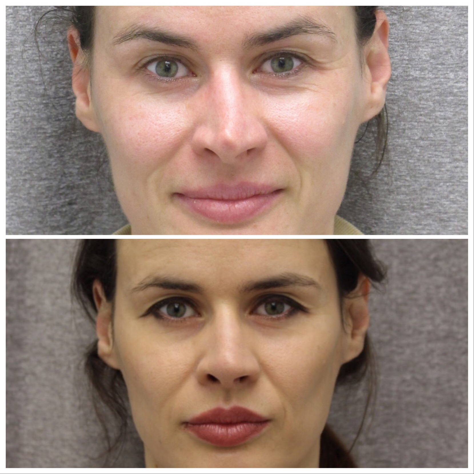 Rhinoplasty Long Island | Nose Job in Long Island