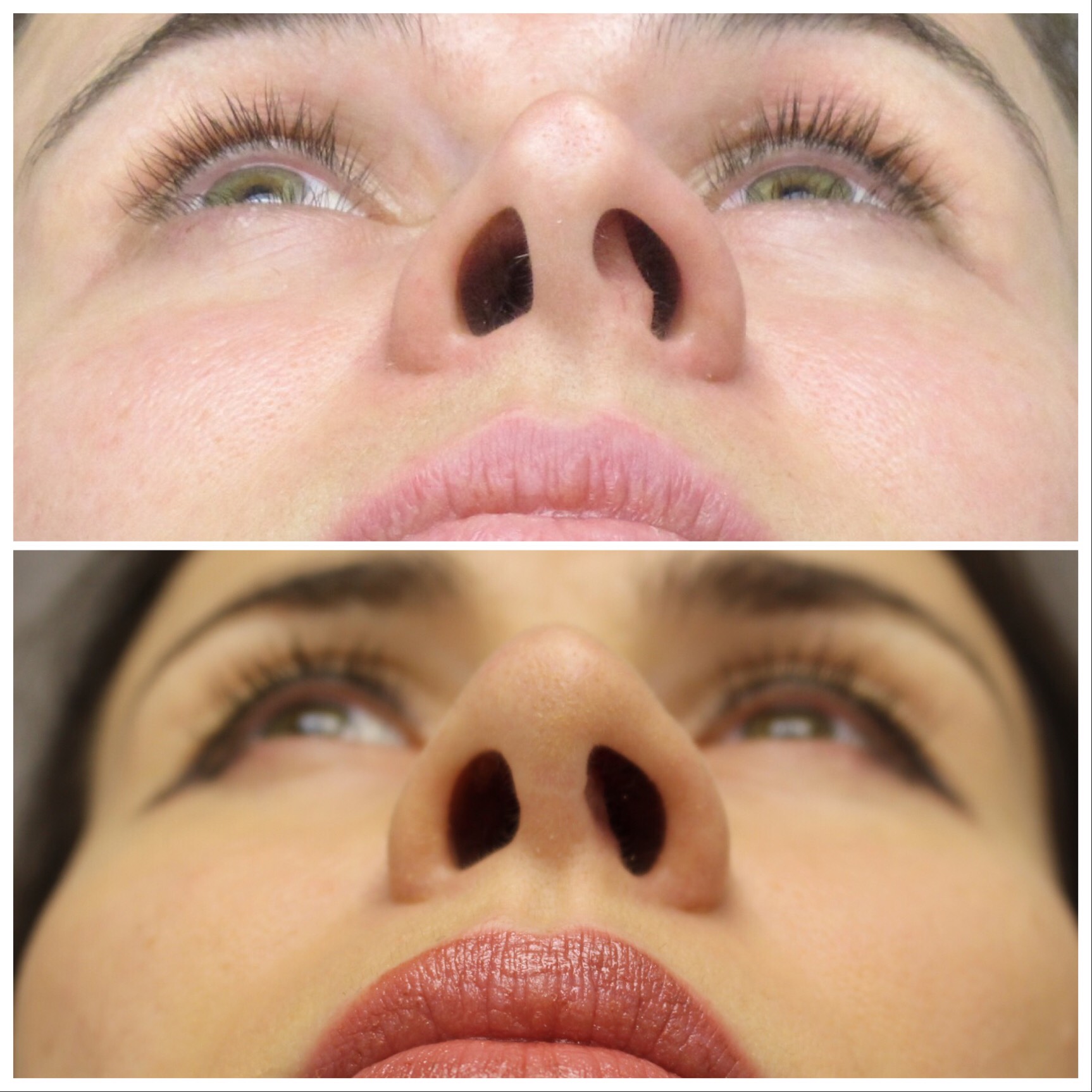 B&A Nose Gallery | Dr. Hardik Doshi in Long Island