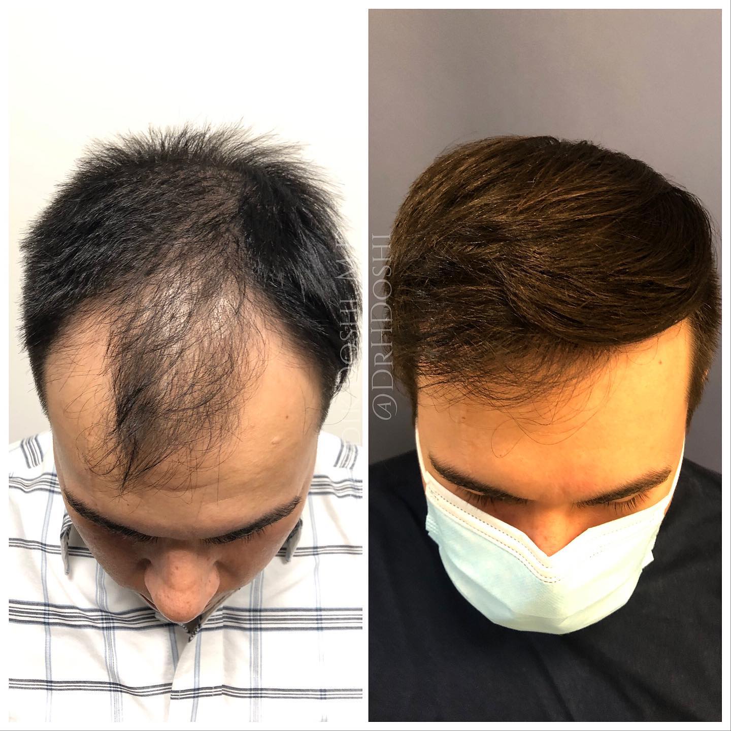Hair Transplant Long Island | Best Hair Transplant Brooklyn