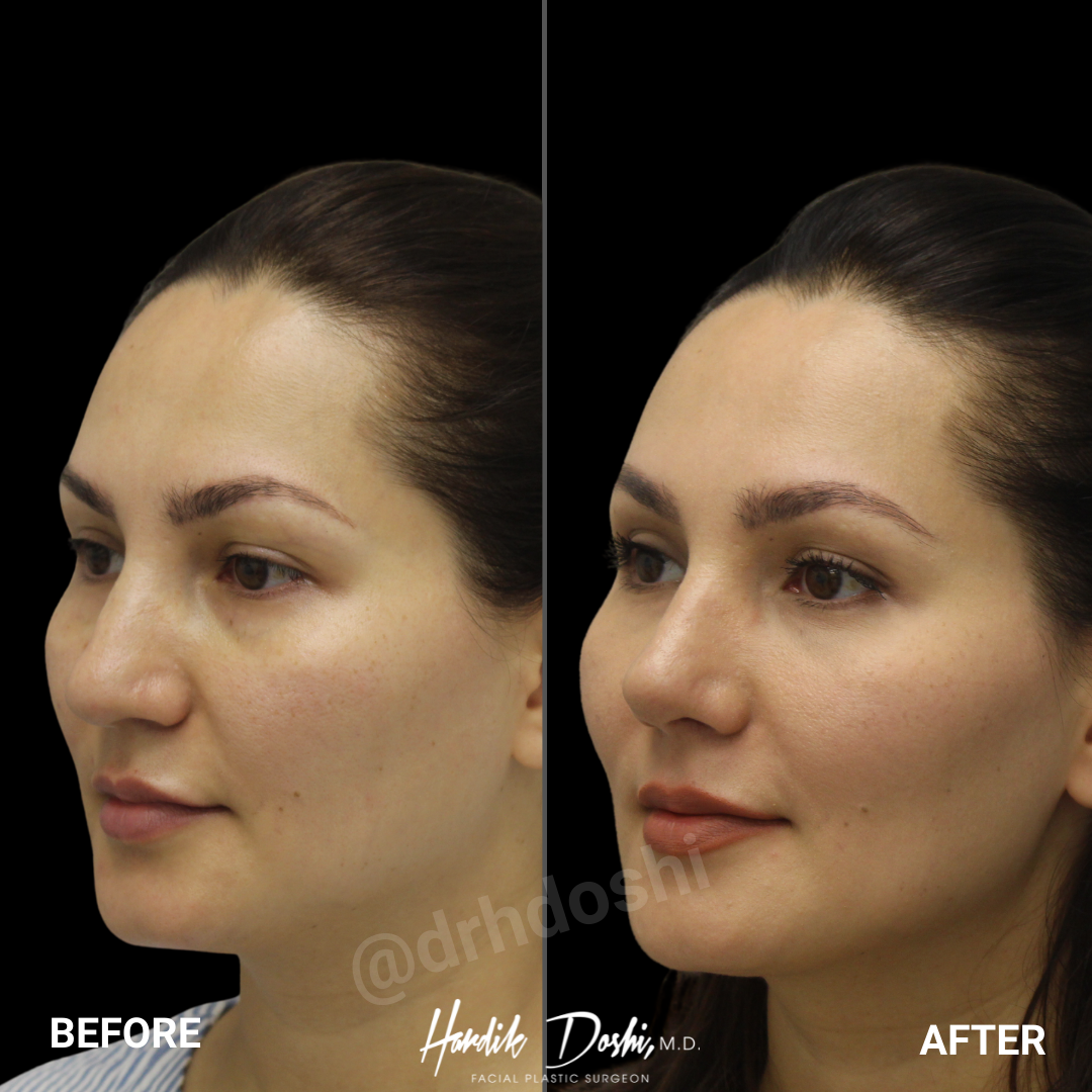 Rhinoplasty Long Island | Nose Job in Long Island