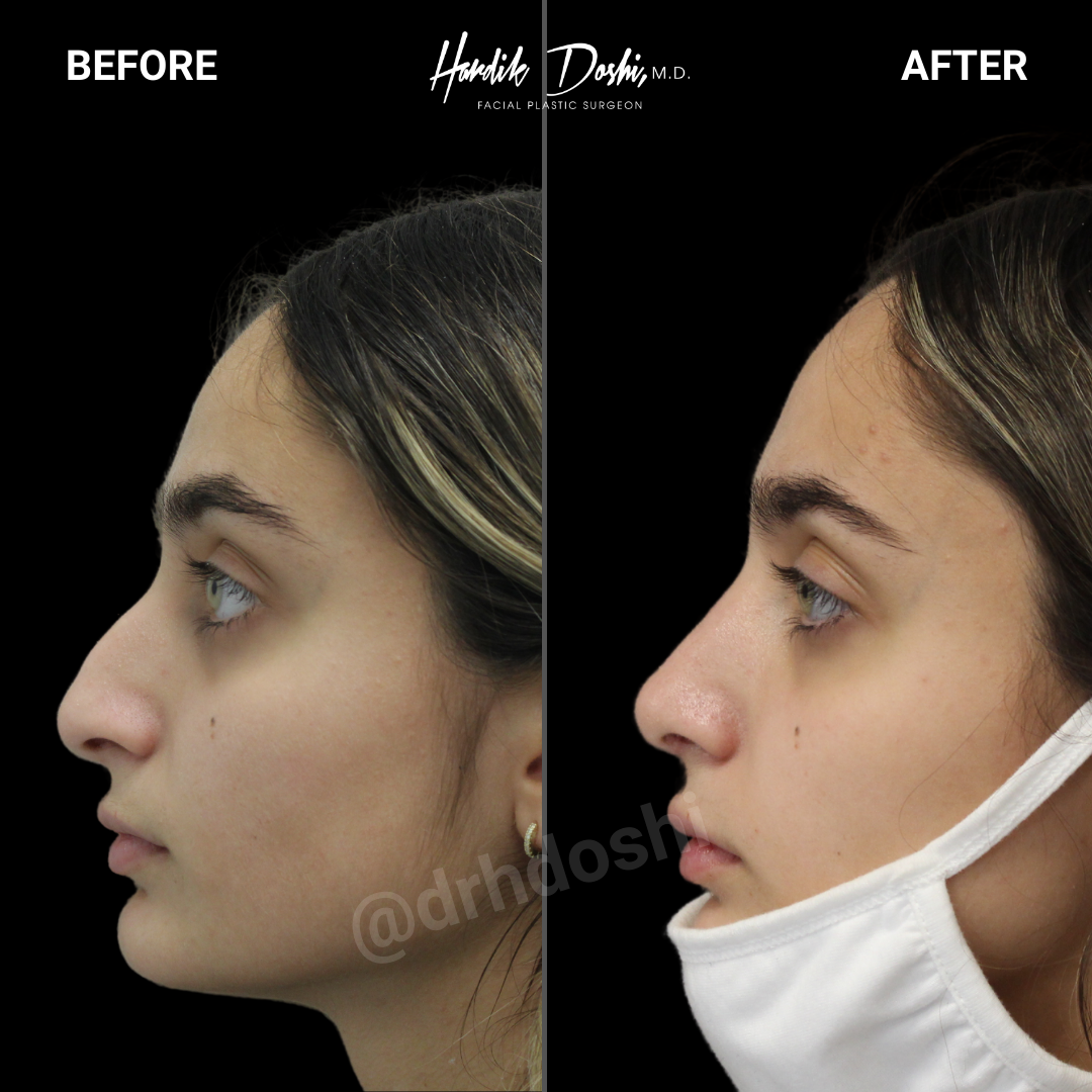 Rhinoplasty Long Island | Nose Job in Long Island