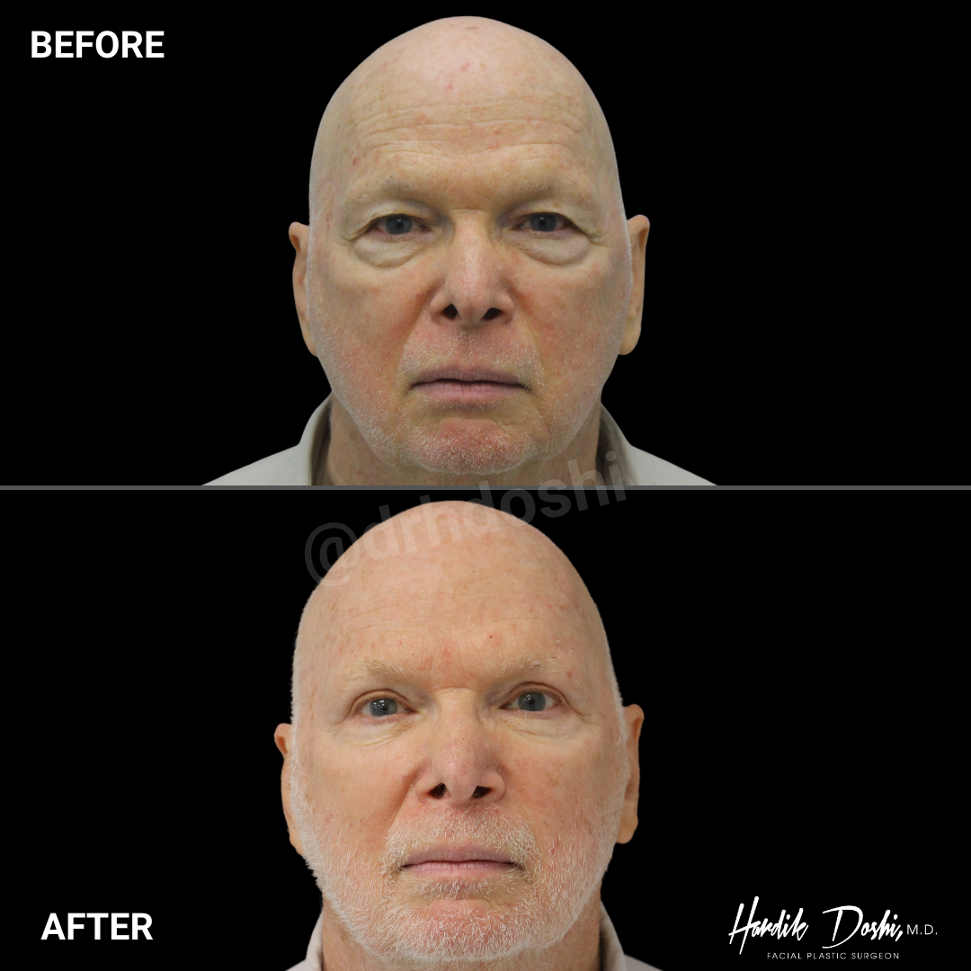 Eyes Before & After Photos | Dr. Hardik Doshi