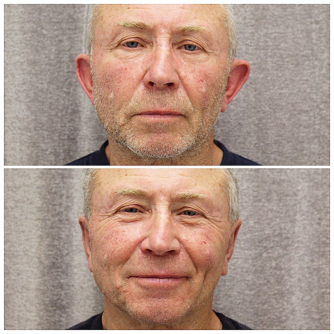 Ears Before & After Photos | Dr. Hardik Doshi