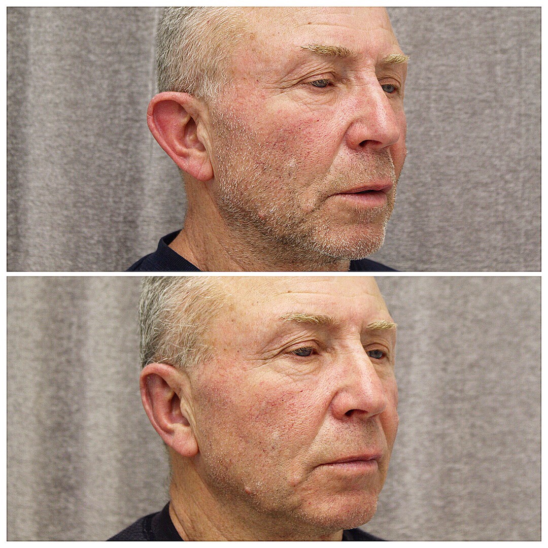 Ears Before & After Photos | Dr. Hardik Doshi