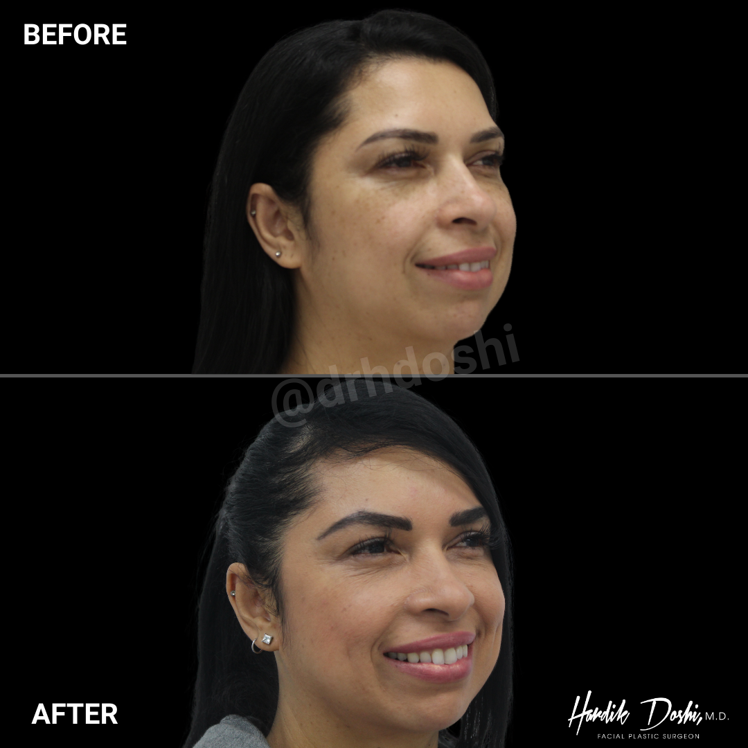 B&A Dimpleplasty Gallery | Dr. Hardik Doshi in Brooklyn