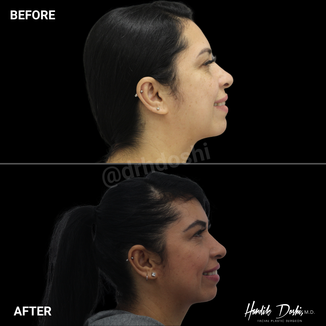 B&A Dimpleplasty Gallery | Dr. Hardik Doshi in Brooklyn