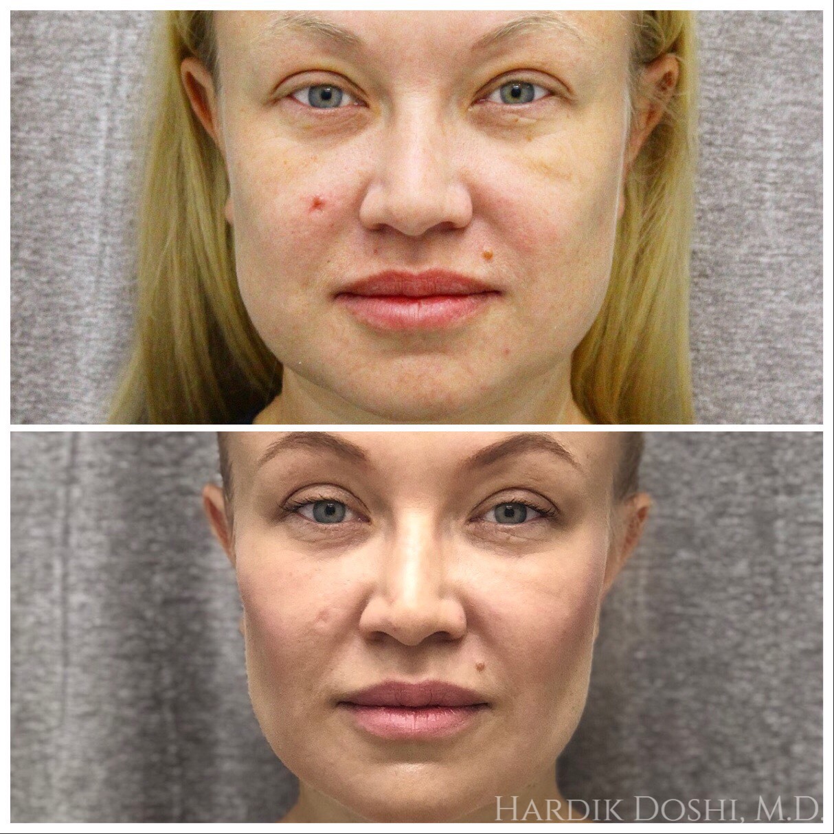 B&A Buccal Fat Gallery | Dr. Hardik Doshi in Brooklyn