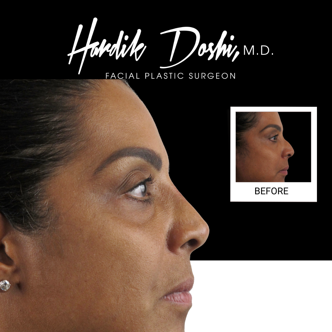 Nose Before & After Photos | Dr. Hardik Doshi