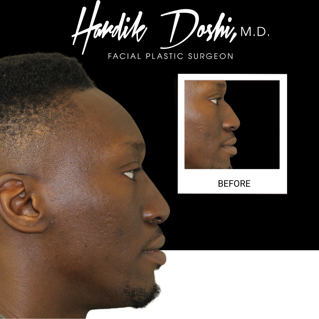 Nose Before & After Photos | Dr. Hardik Doshi