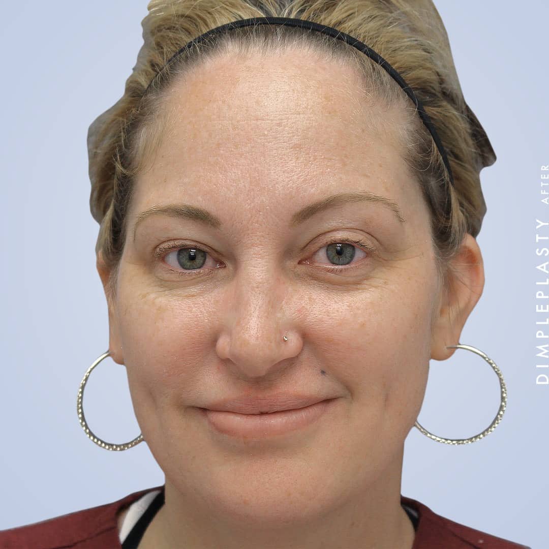 B&A Dimpleplasty Gallery | Dr. Hardik Doshi in Brooklyn