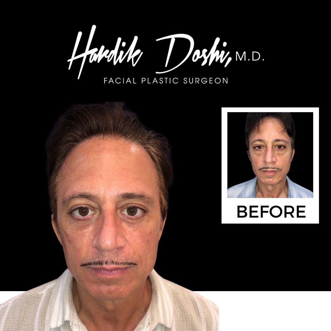 Eyes Before & After Photos | Dr. Hardik Doshi