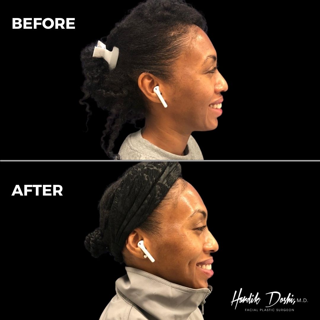 B&A Dimpleplasty Gallery | Dr. Hardik Doshi in Brooklyn