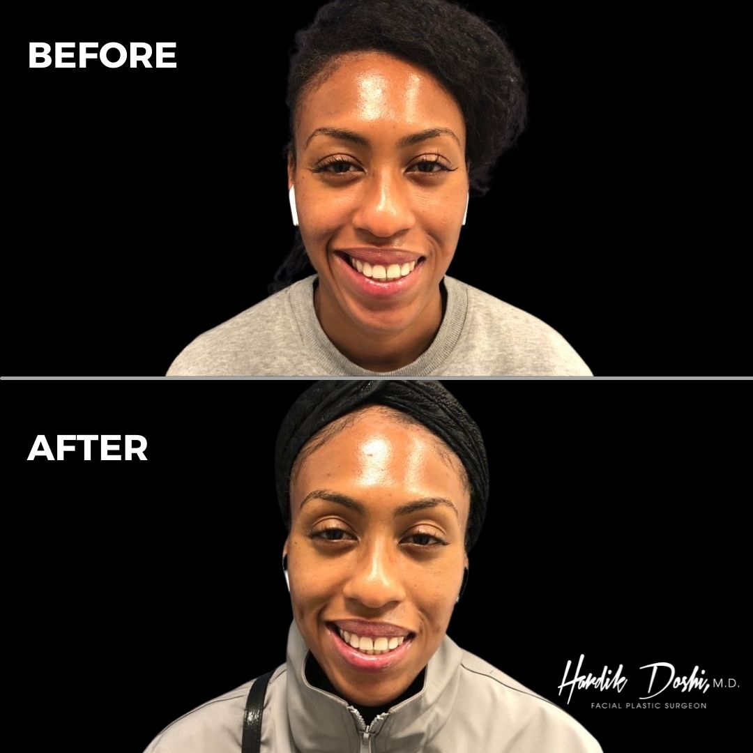 B&A Dimpleplasty Gallery | Dr. Hardik Doshi in Brooklyn