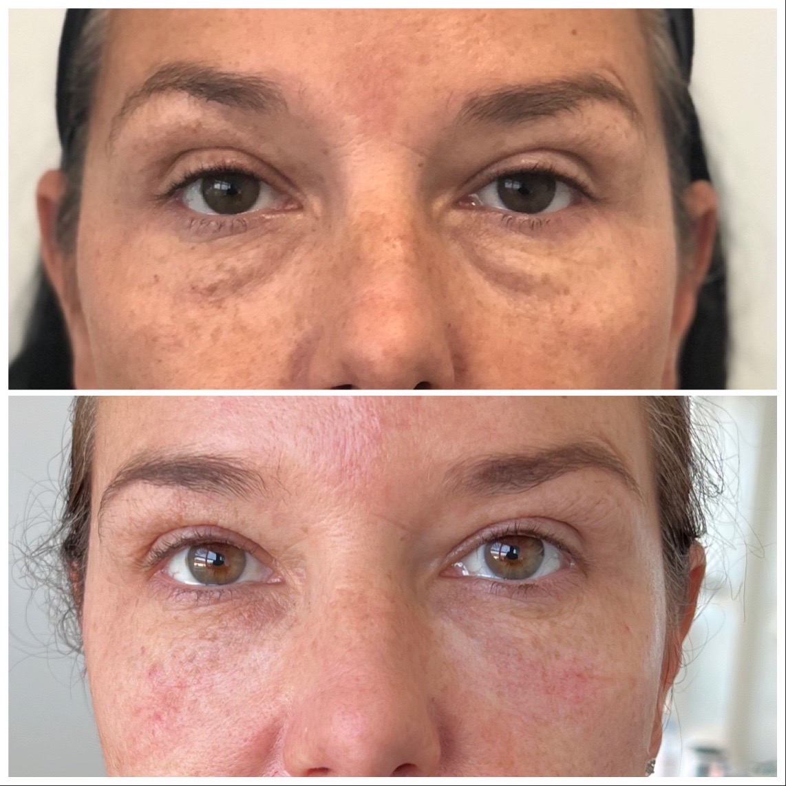 Eyes Before & After Photos in Long Island, NY | Non-Surgical - Dr. Doshi