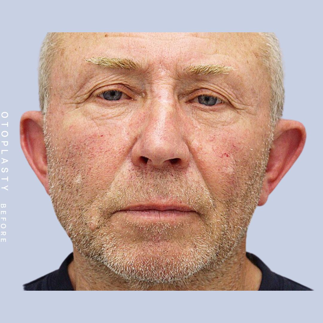 Ears Before & After Photos for Men in Long Island, NY | Dr. Doshi