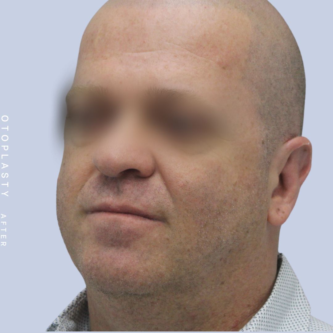 Ears Before & After Photos for Men in Long Island, NY | Dr. Doshi