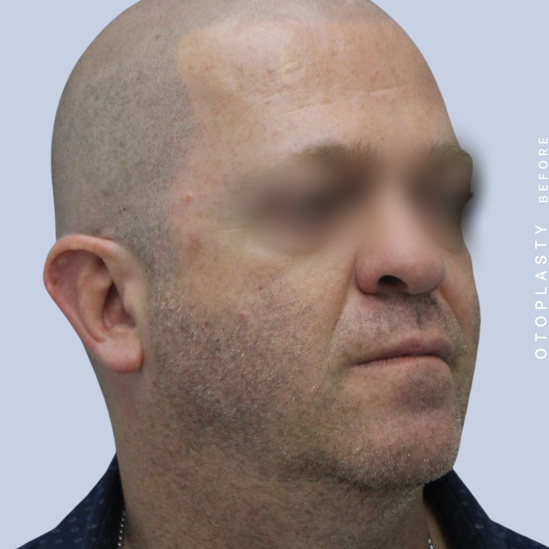 Ears Before & After Photos for Men in Long Island, NY | Dr. Doshi