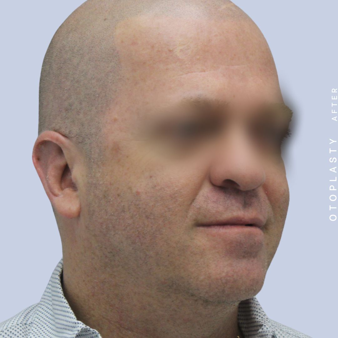 Ears Before & After Photos for Men in Long Island, NY | Dr. Doshi