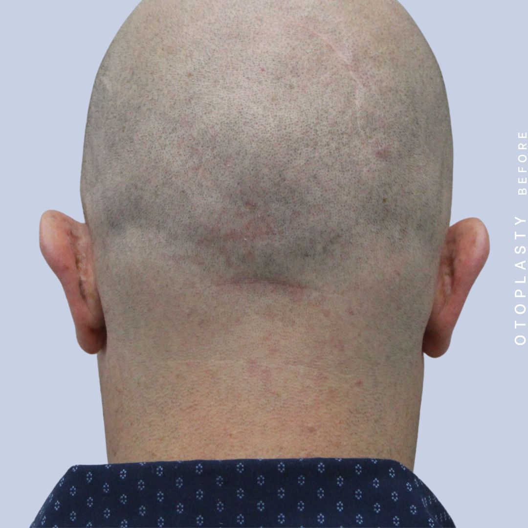 Ears Before & After Photos for Men in Long Island, NY | Dr. Doshi