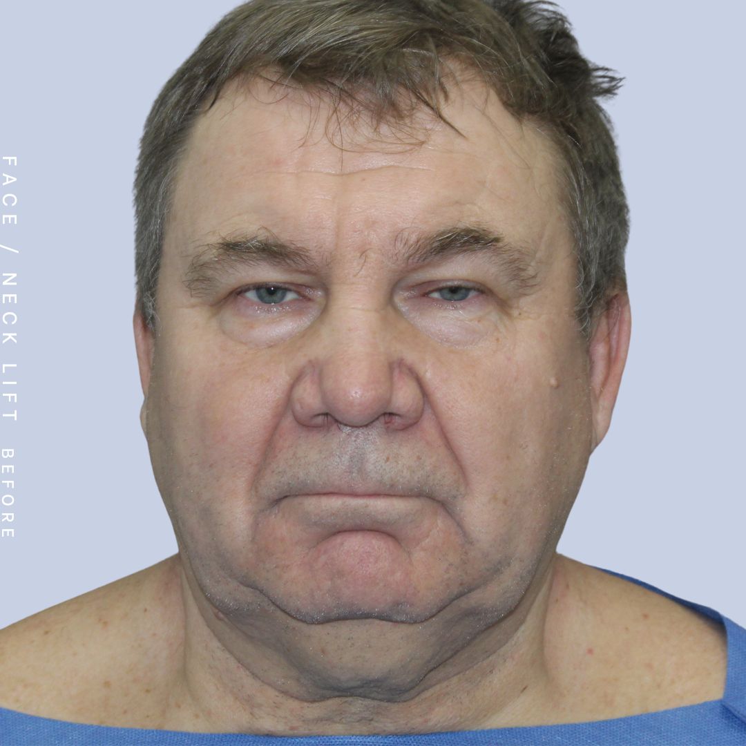 Men's Face & Neck Before & After Photos | Dr. Hardik Doshi