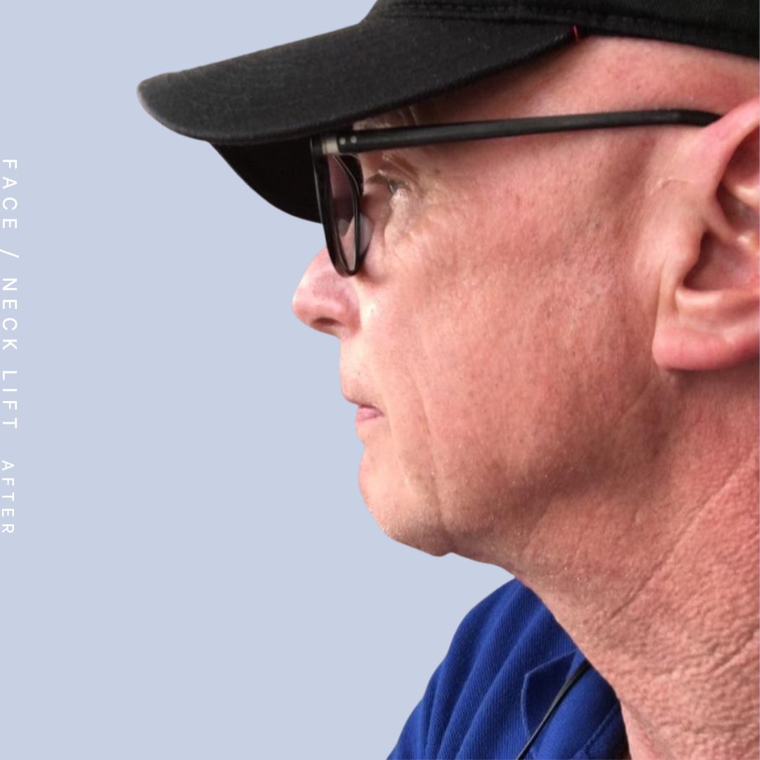 Men's Face & Neck Before & After Photos | Dr. Hardik Doshi