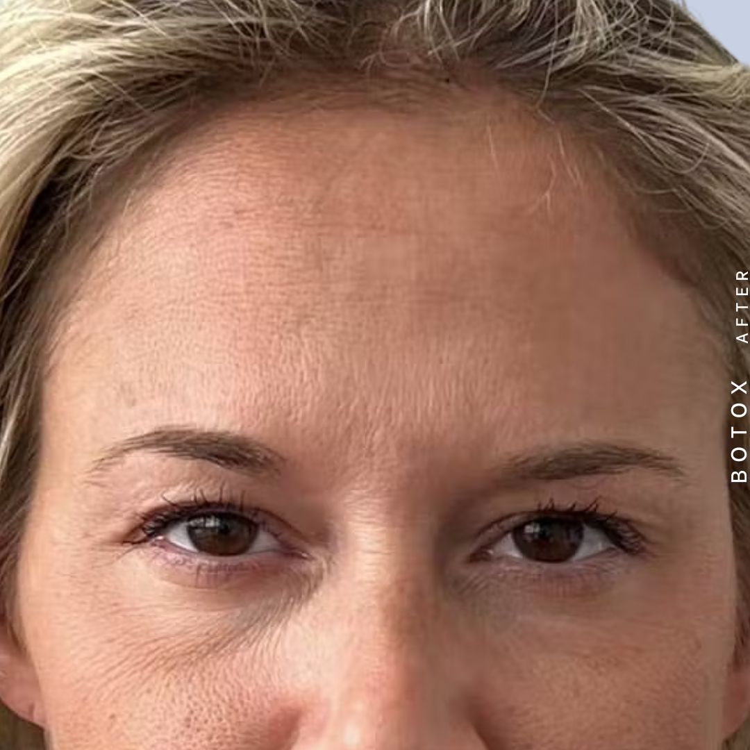 Wrinkles Before & After Photos | Dr. Hardik Doshi