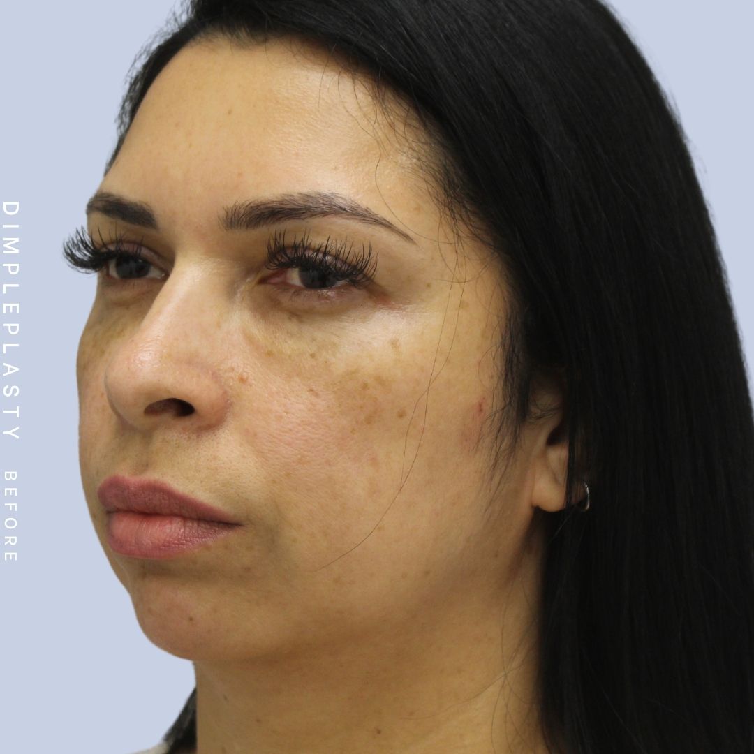 B&A Dimpleplasty Gallery | Dr. Hardik Doshi in Brooklyn