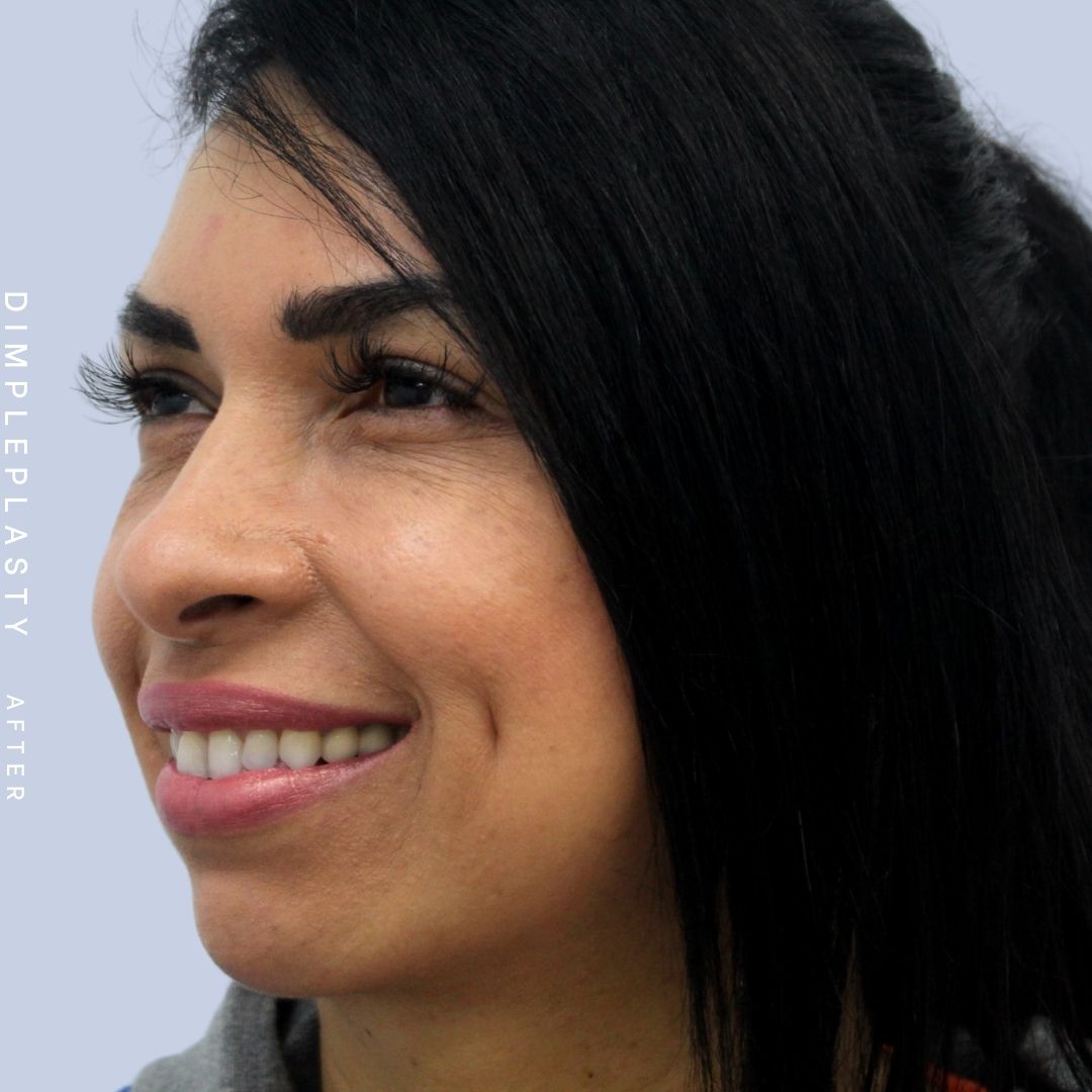 B&A Dimpleplasty Gallery | Dr. Hardik Doshi in Brooklyn