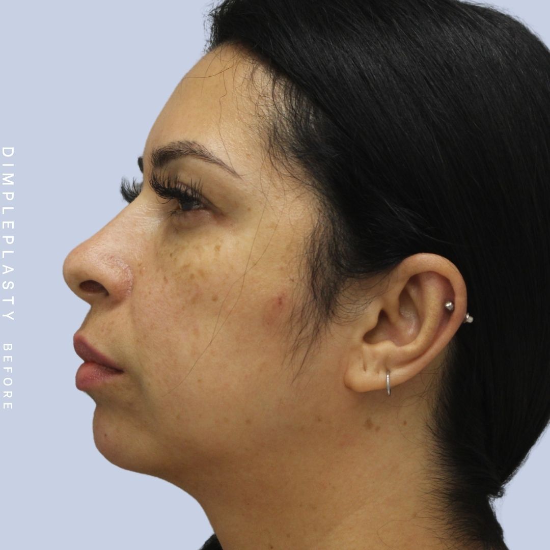 B&A Dimpleplasty Gallery | Dr. Hardik Doshi in Brooklyn