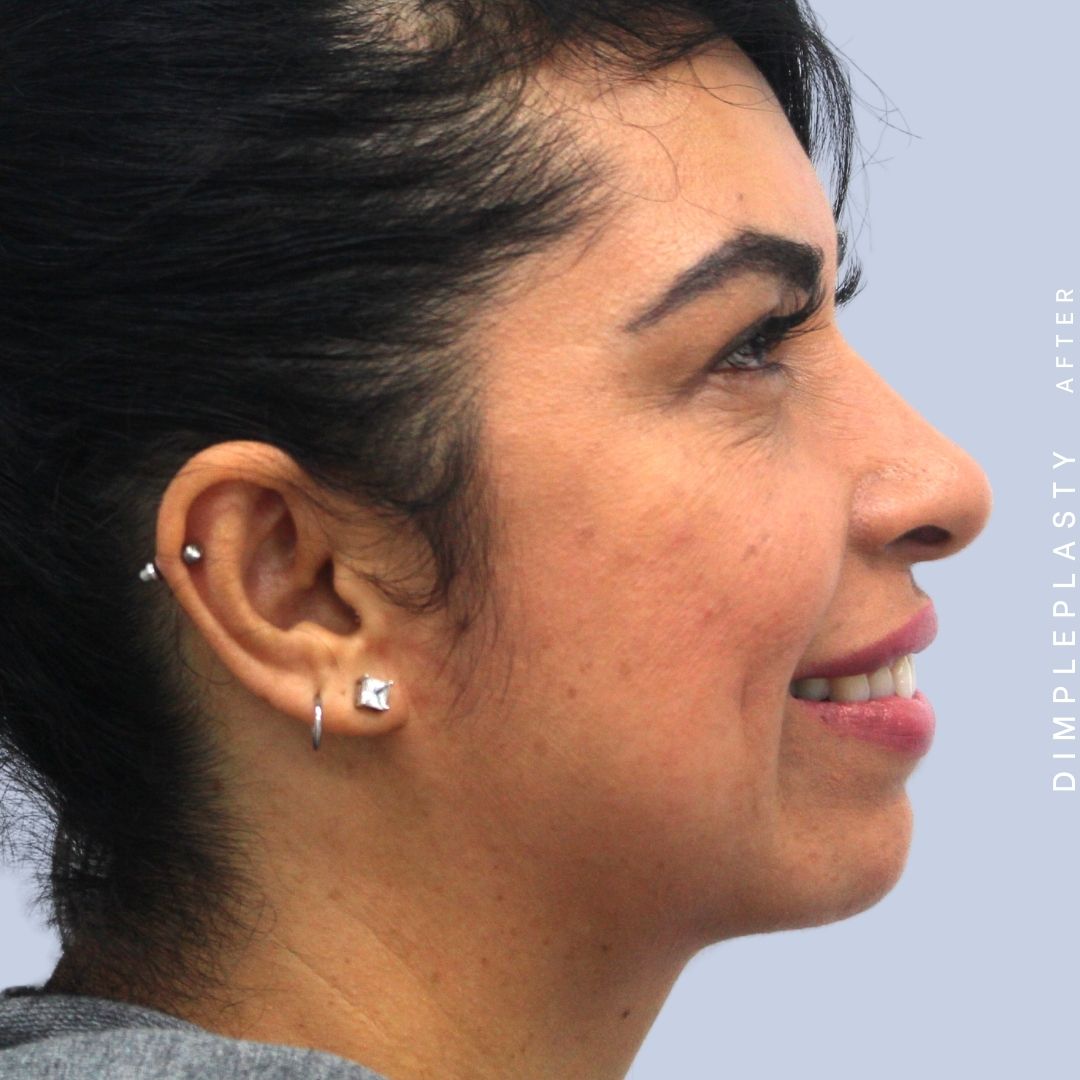 B&A Dimpleplasty Gallery | Dr. Hardik Doshi in Brooklyn