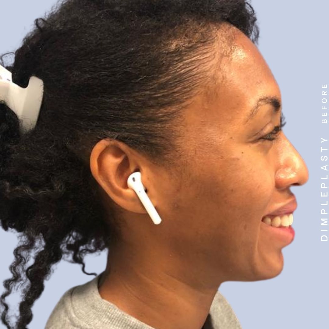 B&A Dimpleplasty Gallery | Dr. Hardik Doshi in Brooklyn