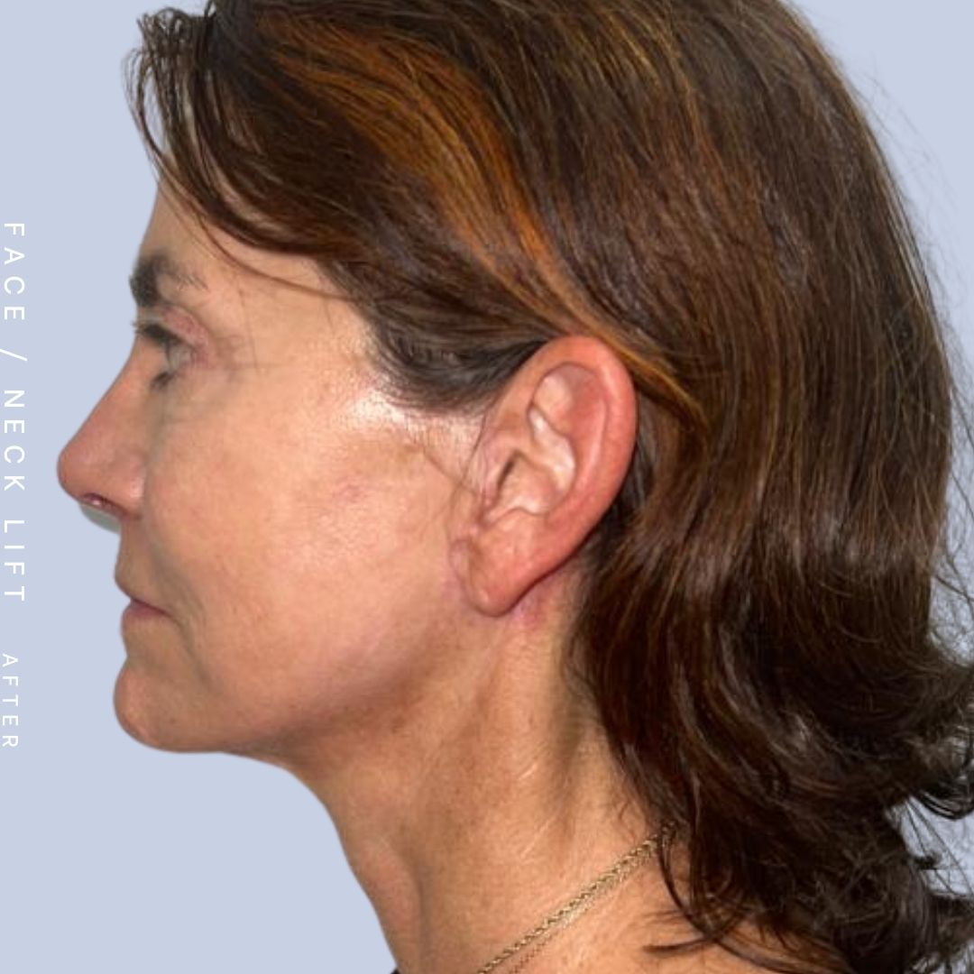 B&A Neck Lift Gallery | Dr. Hardik Doshi in Long Island