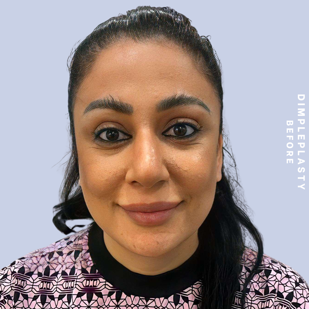 B&A Dimpleplasty Gallery | Dr. Hardik Doshi in Brooklyn