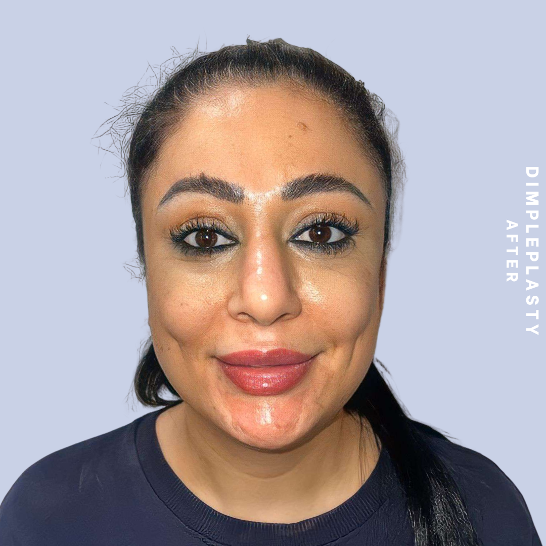 B&A Dimpleplasty Gallery | Dr. Hardik Doshi in Brooklyn