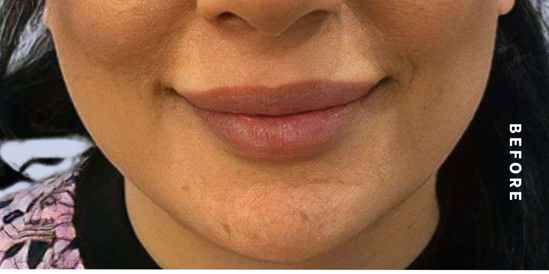 B&A Dimpleplasty Gallery | Dr. Hardik Doshi in Brooklyn