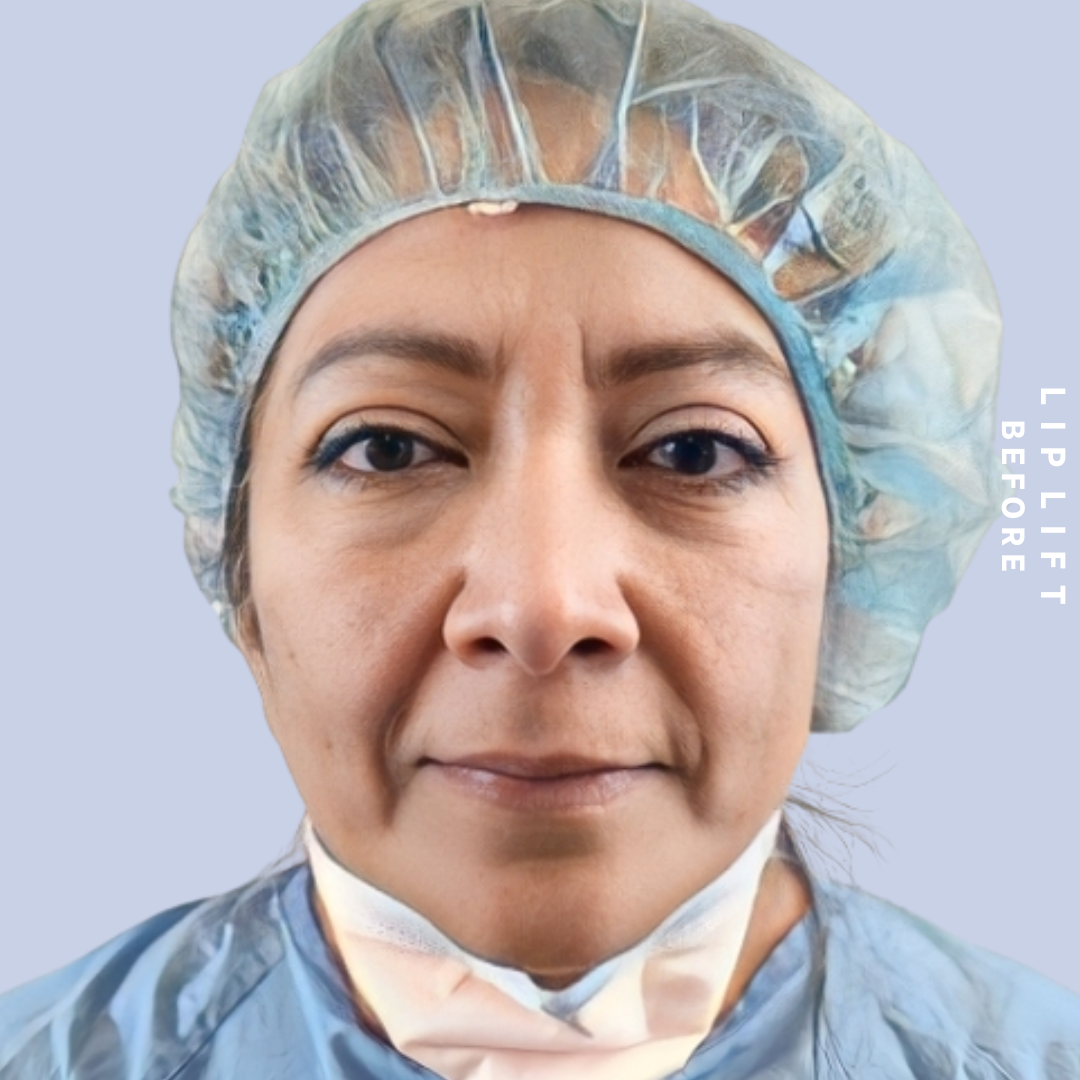 Lips Before & After Photos in Long Island, NY | Plastic Surgery - Dr. Doshi