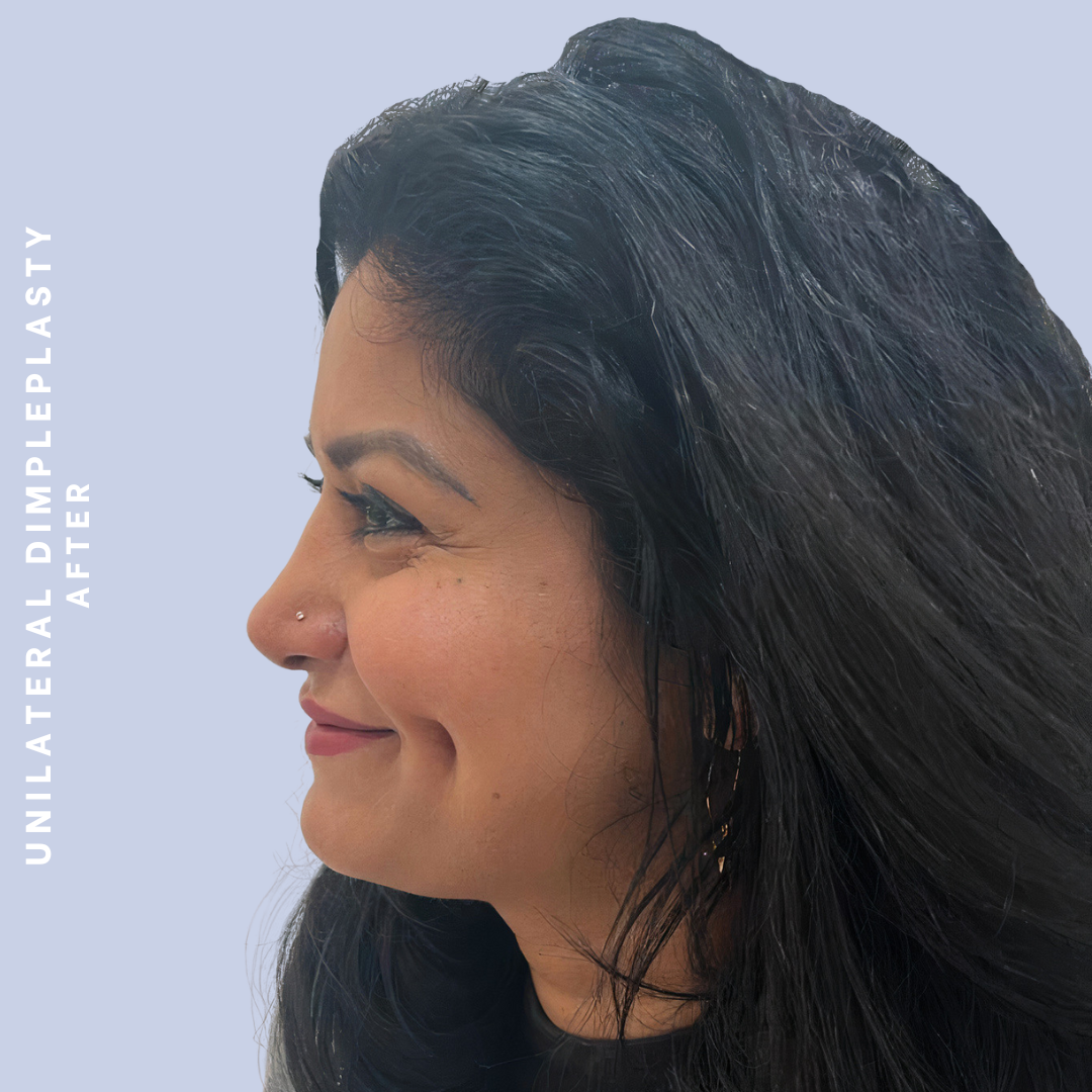 B&A Dimpleplasty Gallery | Dr. Hardik Doshi in Brooklyn