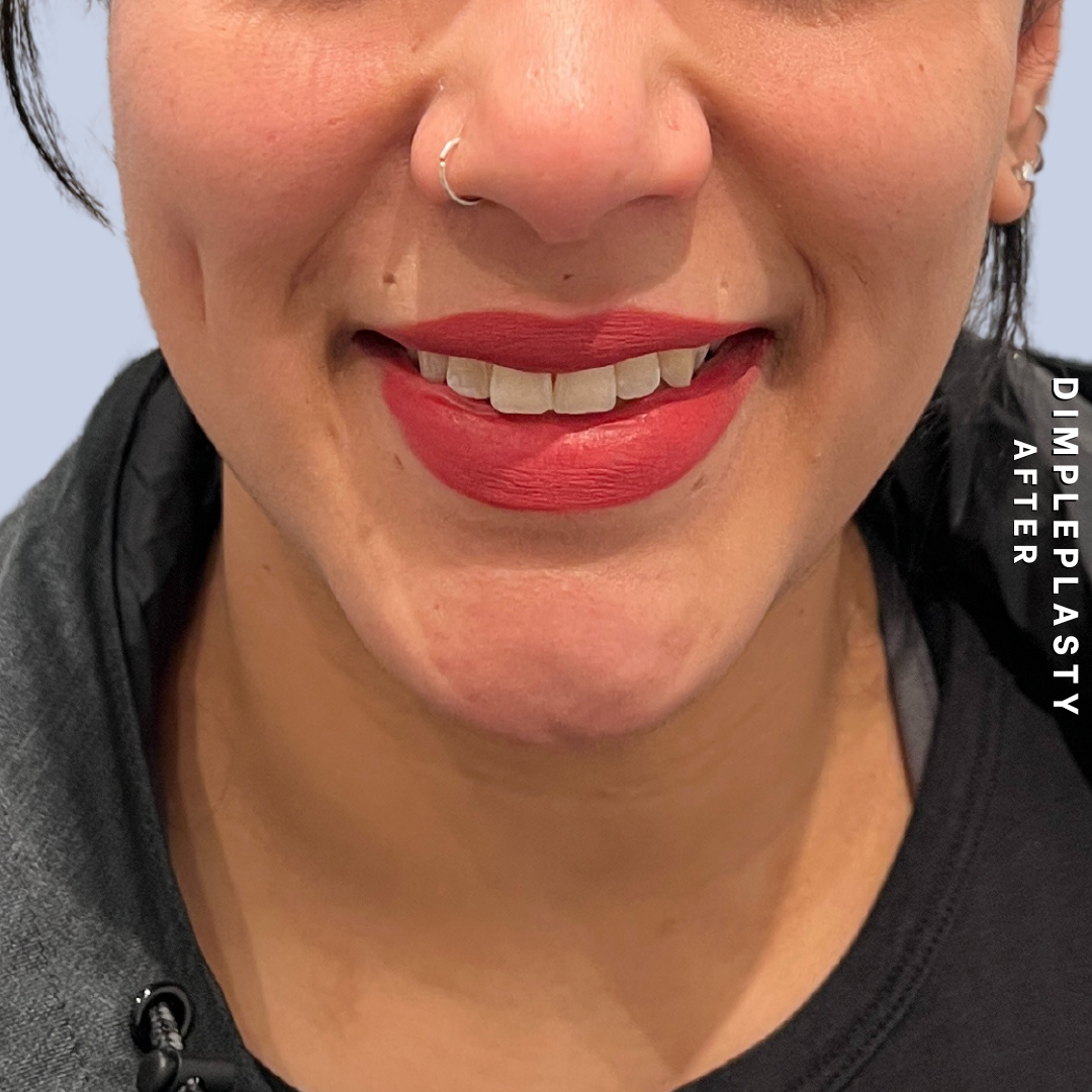 B&A Dimpleplasty Gallery | Dr. Hardik Doshi in Brooklyn