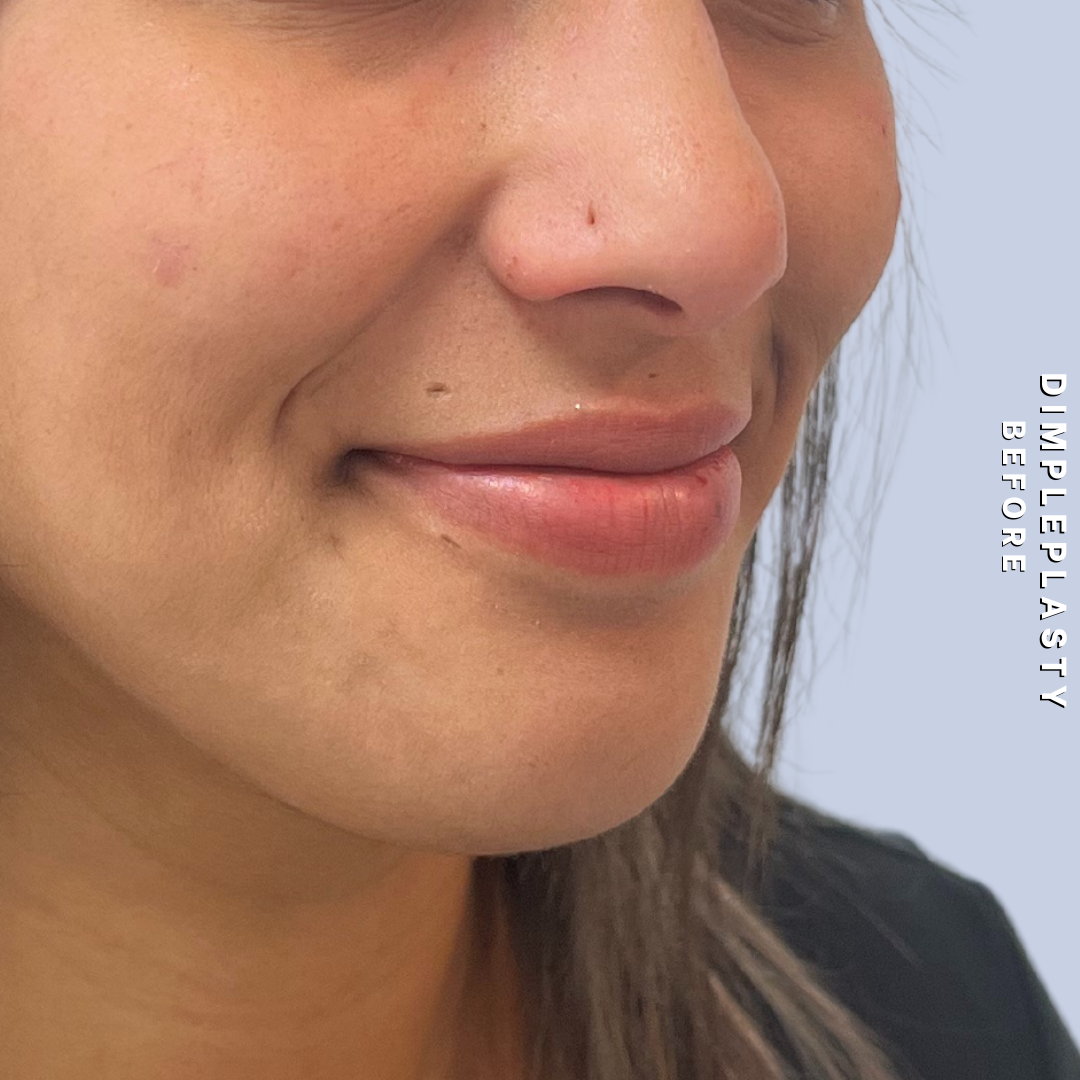 B&A Dimpleplasty Gallery | Dr. Hardik Doshi in Brooklyn