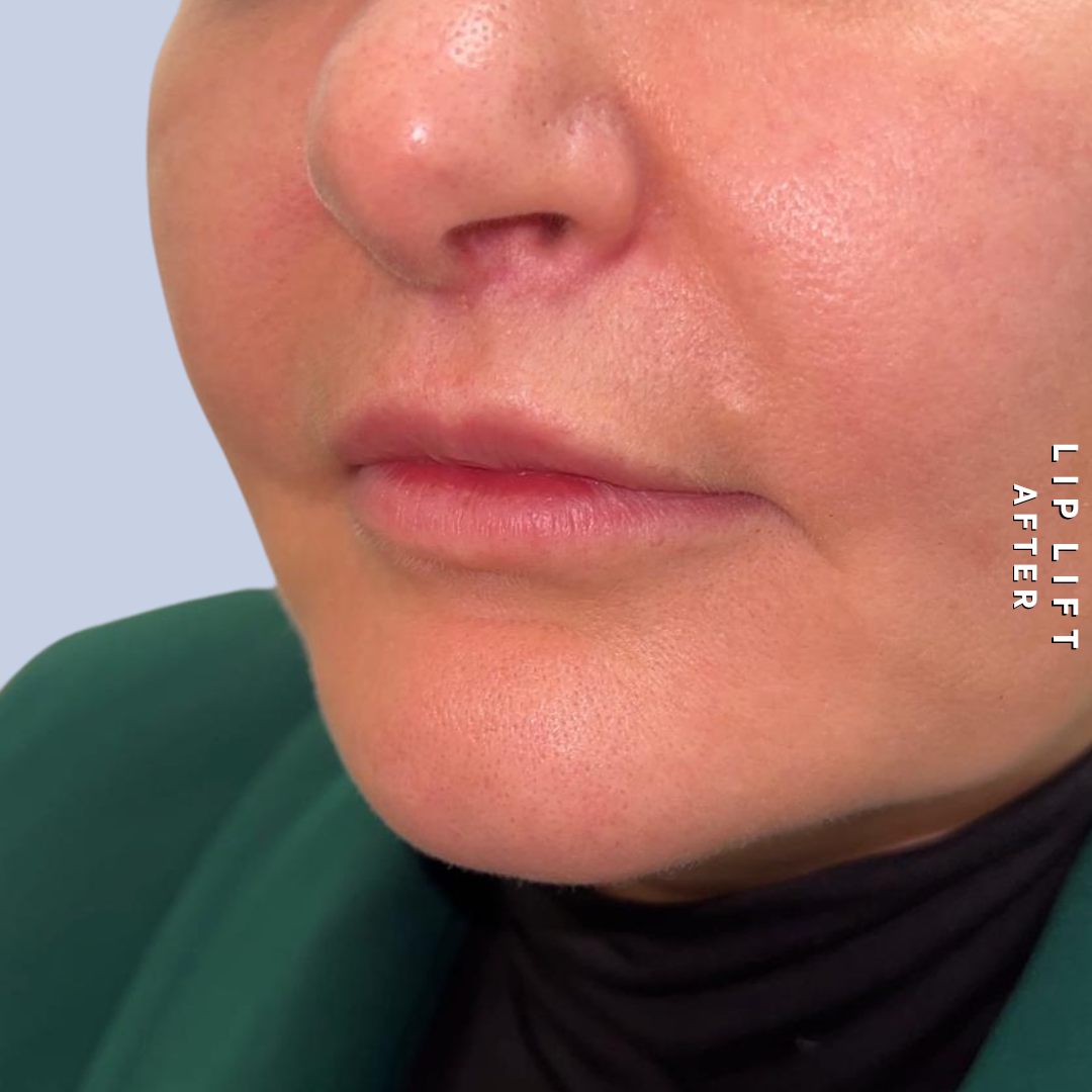Lips Before & After Photos in Long Island, NY | Plastic Surgery - Dr. Doshi