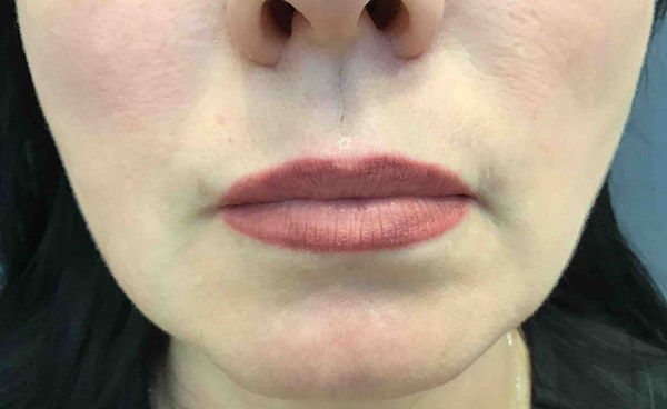 BOTOX Brooklyn, NY | BOTOX in Manhattan