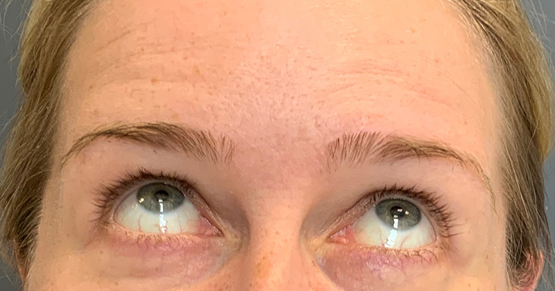 BOTOX Brooklyn, NY | BOTOX in Manhattan