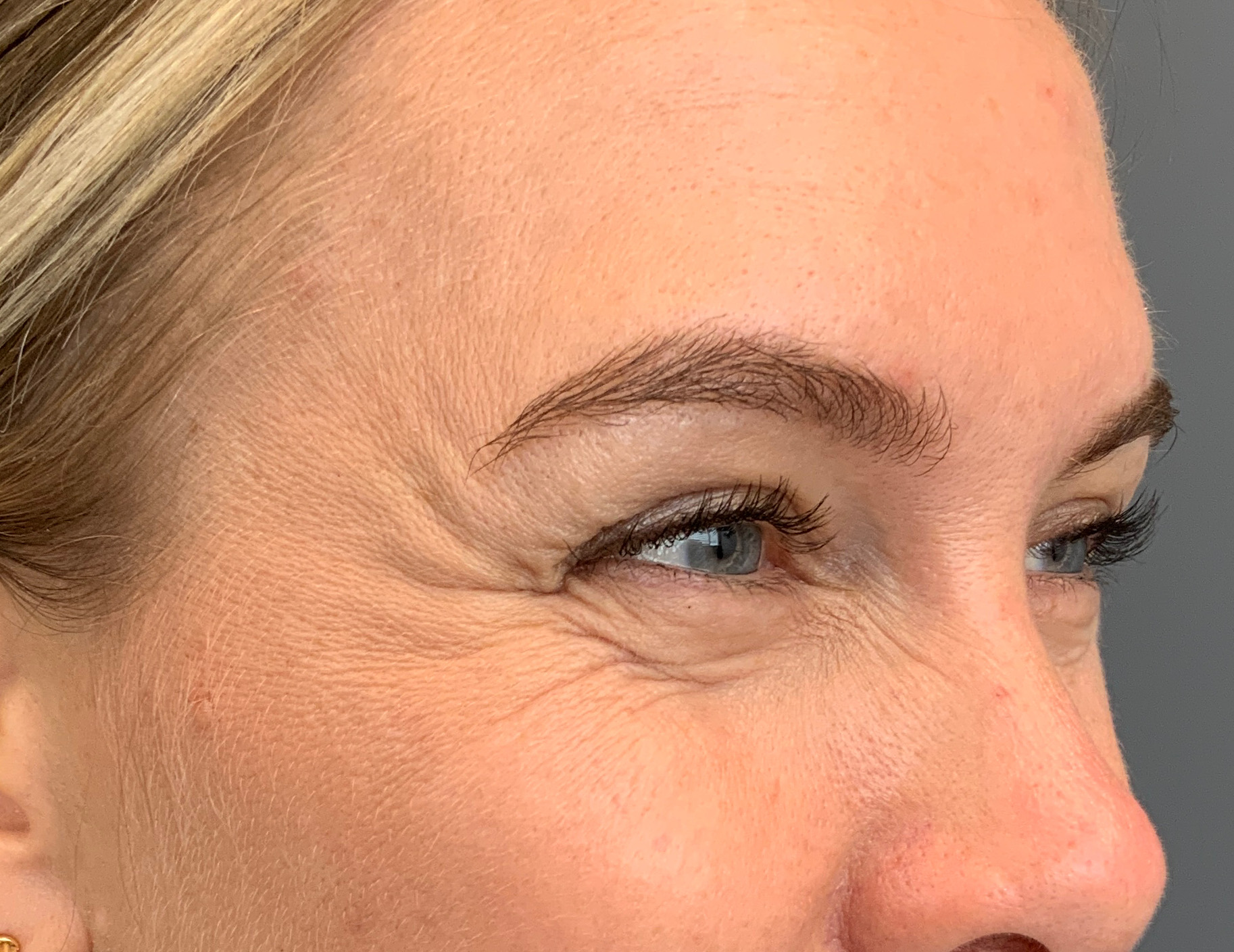 BOTOX Brooklyn, NY | BOTOX in Manhattan