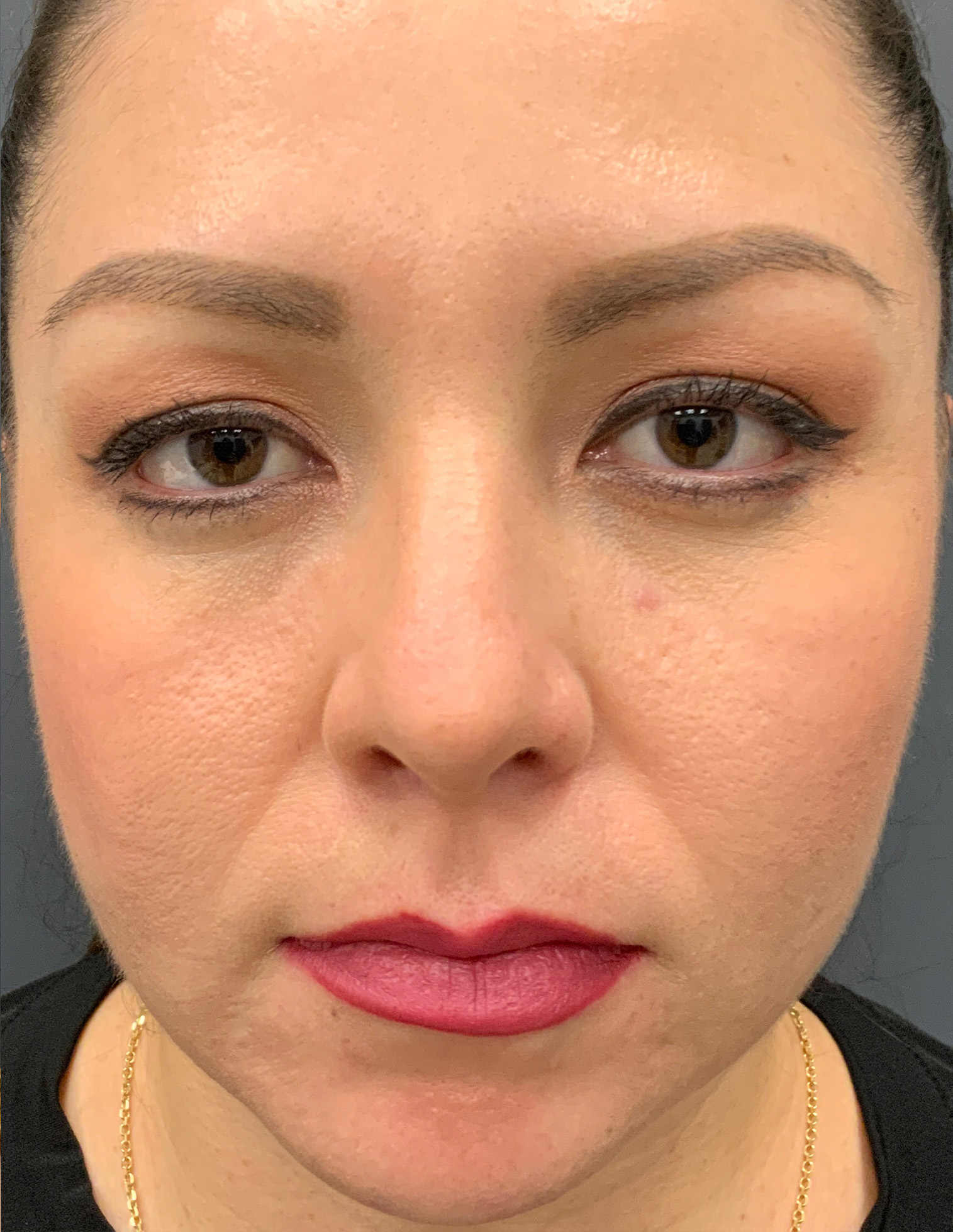 BOTOX Brooklyn, NY | BOTOX in Manhattan