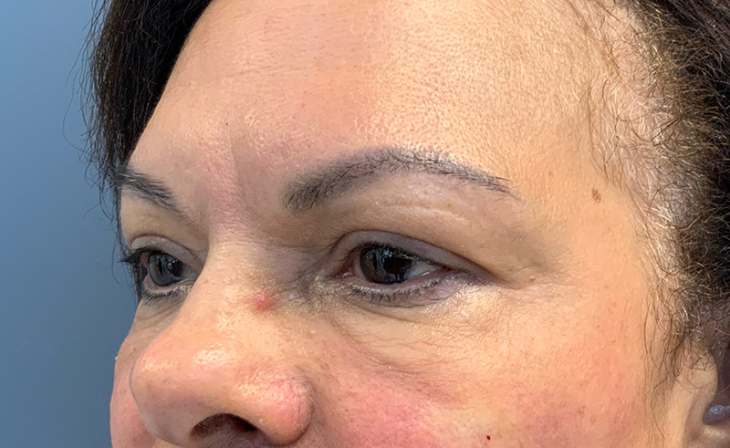 BOTOX Brooklyn, NY | BOTOX in Manhattan