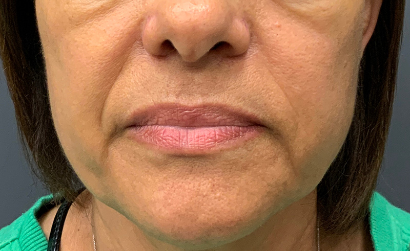 BOTOX Brooklyn, NY | BOTOX in Manhattan