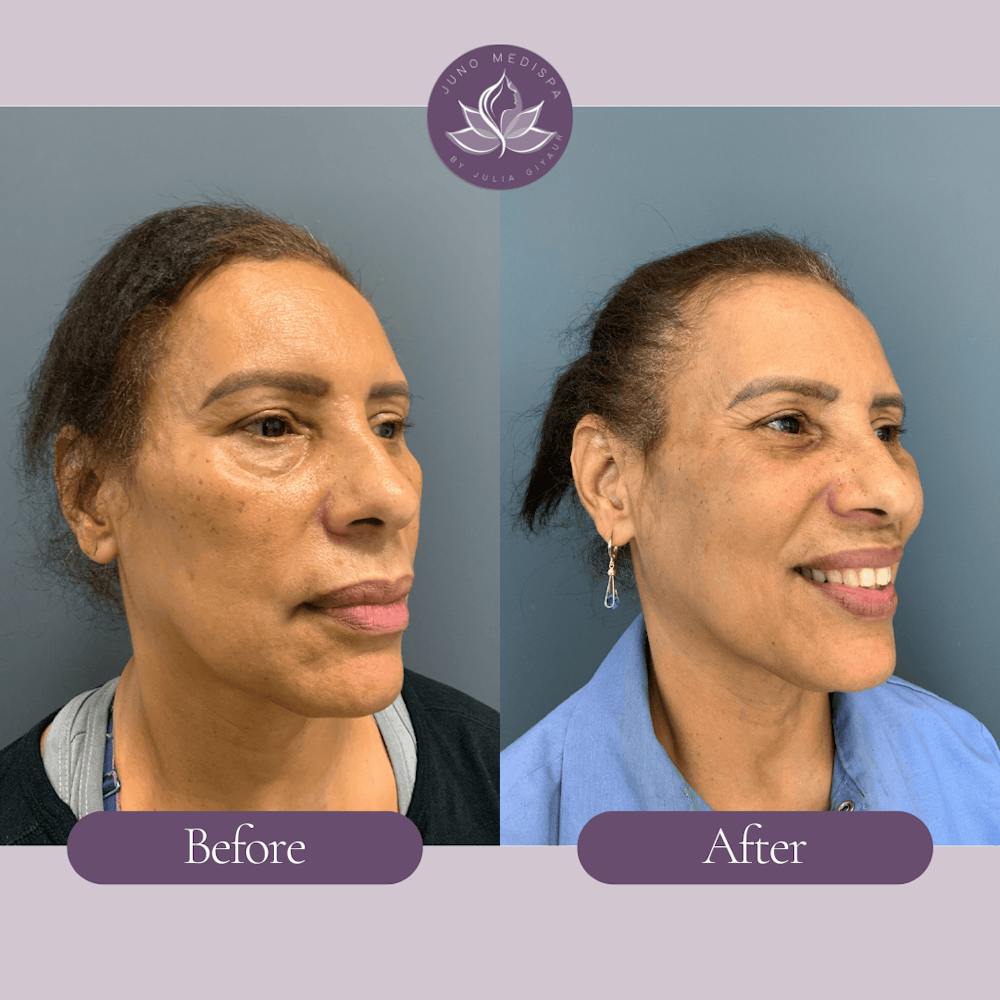 Patient 248666 | Blepharoplasty Before & After Photos | New York Laser ...