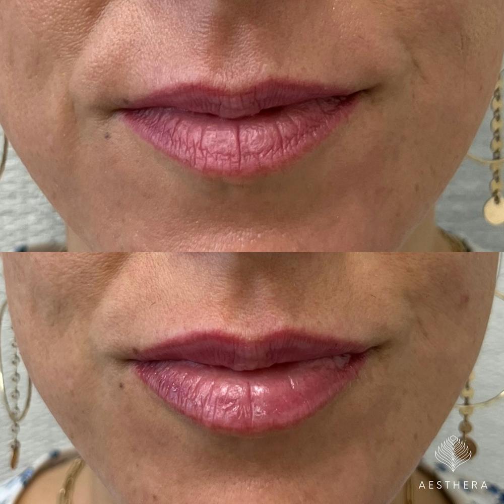 Patient 128775 | Lip Enhancement Before & After Photos | Aesthera MedSpa
