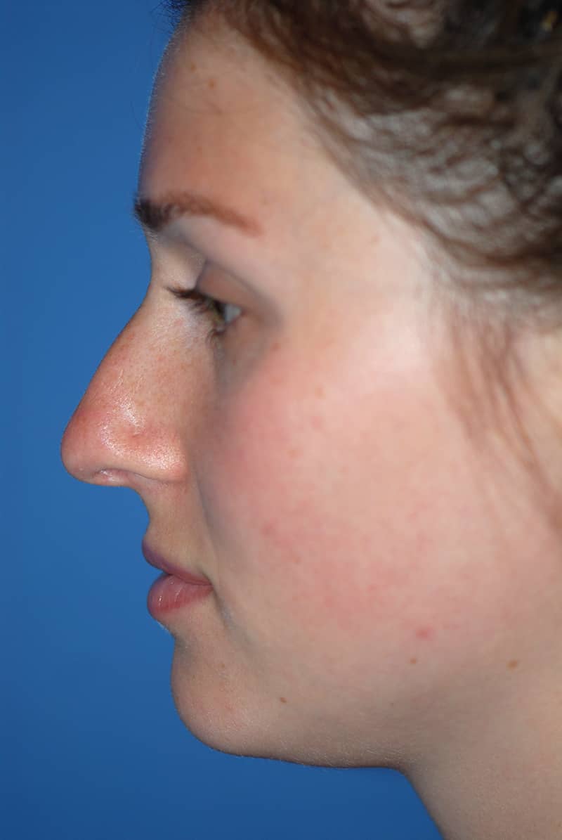 Rhinoplasty Staten Island | Nose Job in Staten Island